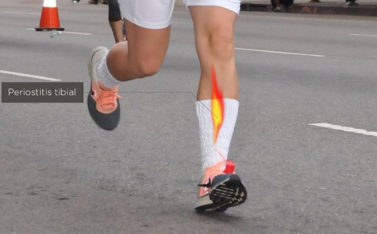 Causas y tratamiento de la periostitis tibial